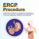 ERCP Explained by the Best Gastroenterologist in Delhi-2024
